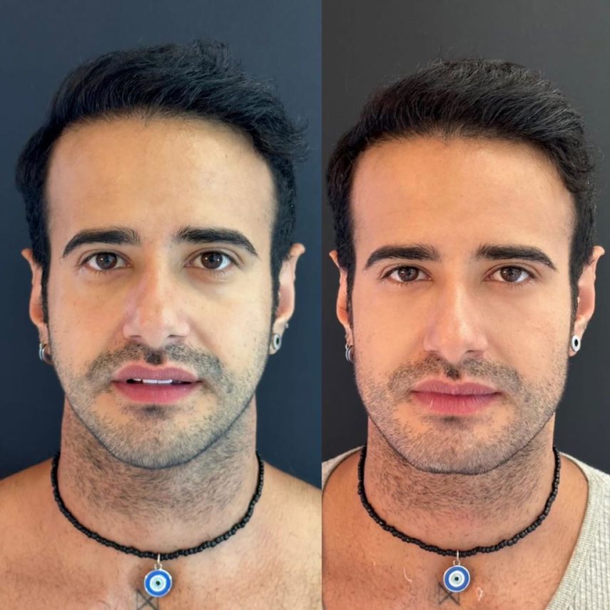 Tarso Brant passa por procedimento facial com Gabriela Dawson – Vírgula